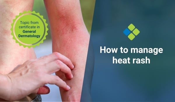 Heat rash remedies store